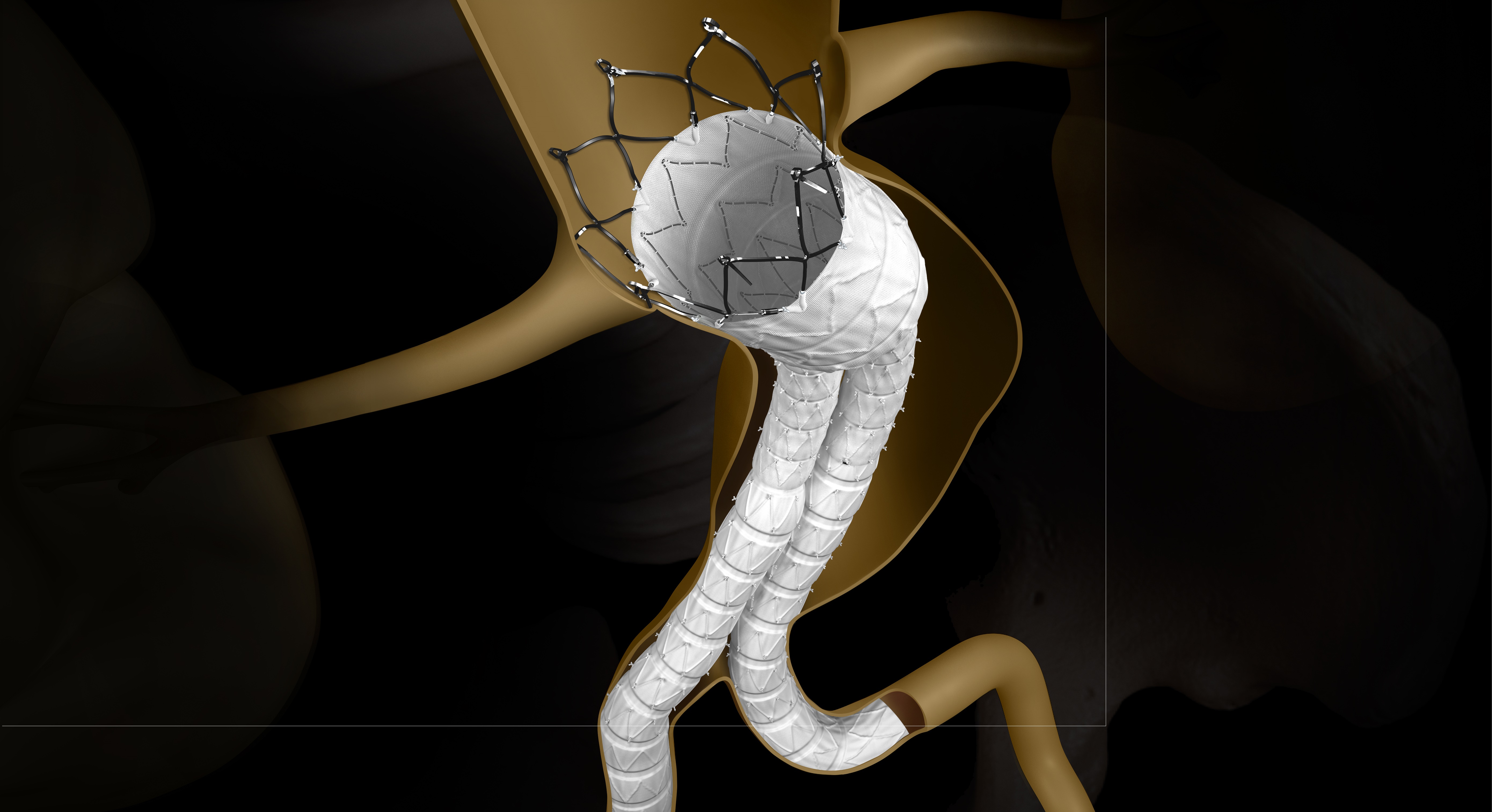 FDA Advisory Panel Gives Thumbs Up to EVAR System | tctmd.com